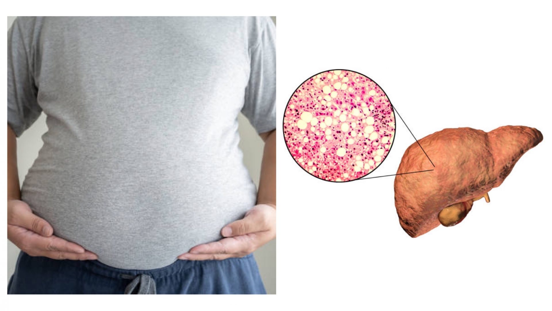 The Link between Obesity and Fatty Liver Disease:Exploring the ...